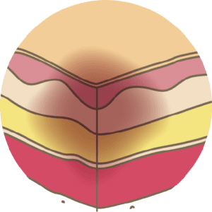 What Are Pressure Sores? | KARMA Medical